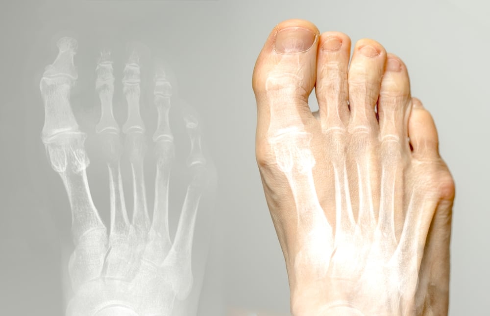 Cartiva Implant Lawsuit | Ferrer Poirot Feller